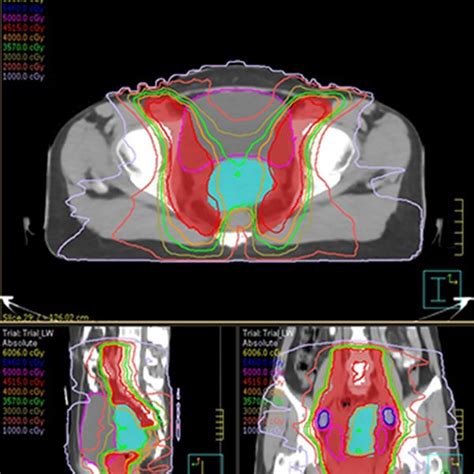 An Example Of Dose Distributions For The Modified Volumetric‐modulated Download Scientific
