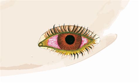 Conjunctivitis Joint Colleges Training Services Jcts