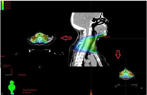 Three Dimensional Conformal Radiotherapy 3dcrt Plan Of Involved Fi Download Scientific