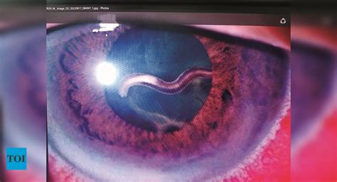 City Doctors Remove Live Roundworm From Monks Eye Chennai News