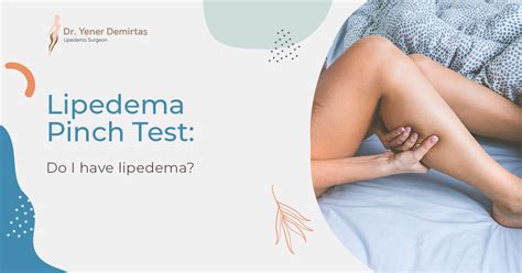 What Is The Skin Pinch Test For Scleroderma At Lorelei Rios Blog