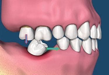 Replacing Missing Teeth Is Important To Prevent Neighbouring Teeth From