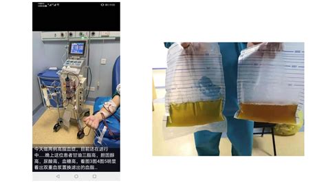 血液净化治疗模式以及血液净化治疗高脂血症 再造人
