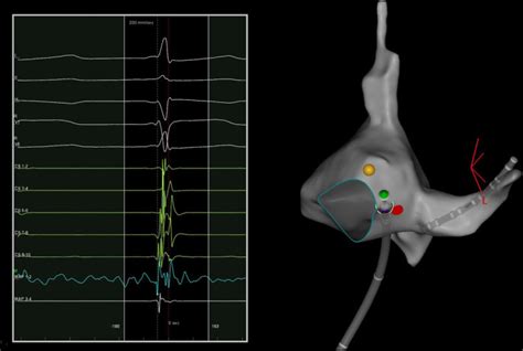Irrigated Contact Force Sensing Catheter For Redo Ablation Of Slowfast Atrioventricular Nodal