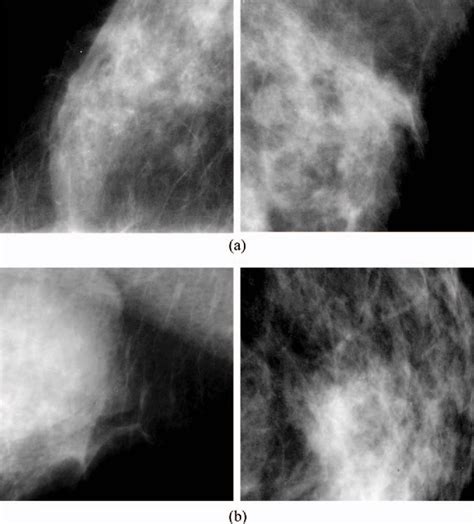 Figure 6 From Analysis Of Perceived Similarity Between Pairs Of Microcalcification Clusters In