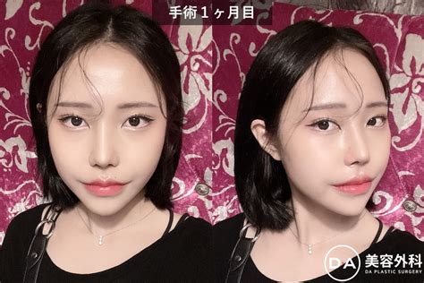 【韓国整形・輪郭整形】人形みたいな顔のラインを作る方法！、da輪郭3点ダウンタイム 韓国da美容外科【韓国整形・美容整形】