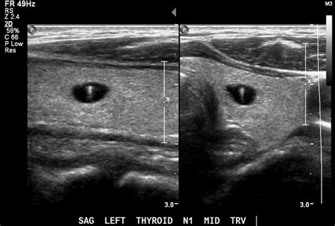 Thyroid Nodule Ultrasound