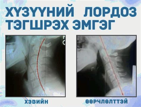 ⁉️Хүзүүний лордозын эмгэг гэж юу вэ Хүзүүний лордоз гэдэг нь хүзүү нурууны сервикаль хэсгийн