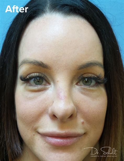 Brow Lift Dr Schalit Cosmetic Facial Specialist