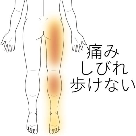 臀部～つま先まで痛みとしびれがあり、歩くことができない｜坐骨神経痛のツボ｜ツボネット 鍼灸の症例が検索できるツボ辞典
