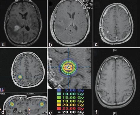 Dr Arun L Naik Stereotactic Surgery