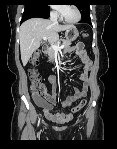 Appendix Mucocele Radiopaedia An Elliptical 65x45x40 Cm In Size Cystic Structure Dependent On