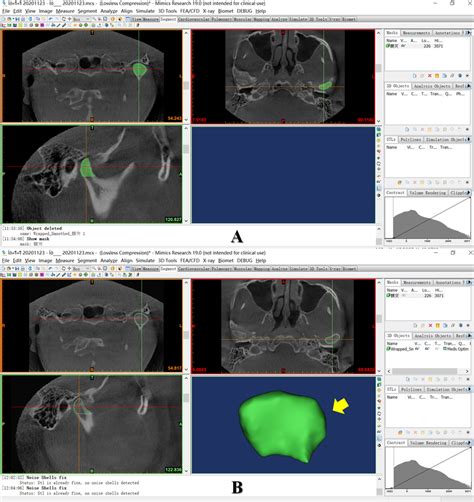 Reconstruction Of The Condyloid Process A Use Of The Multiple Slice