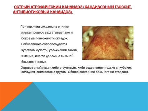 Кандидоз полости рта у детей - презентация онлайн