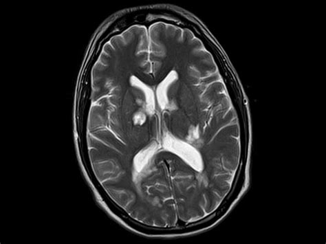 Old Antibiotic May Slow Conversion From Cis To Ms
