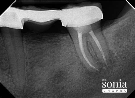 A Tooth Story Of Necrotic Pulp Diagnosis Sonia Chopra Dds
