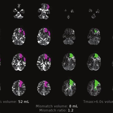 Automated Analysis Of Computed Tomography Perfusion Showing Cerebral Download Scientific