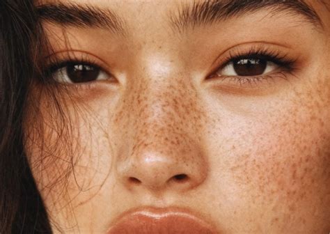 Freckles Types Causes Symptoms And Treatment 2026