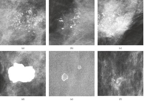Table 1 From Breast Microcalcification Diagnosis Using Deep Convolutional Neural Network From