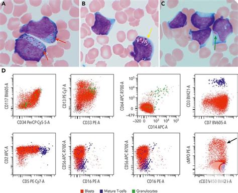 Pediatric Mixed Phenotype Acute Leukemia T Myeloid With Isolated Flt3 Mutation