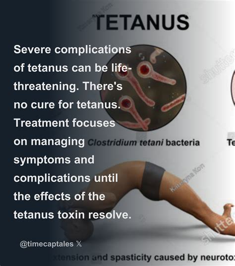 Fasc1nate Severe Complications Of Tetanus Can Be Life Threatening