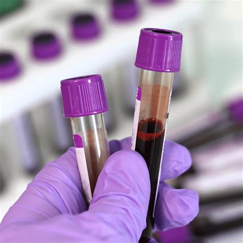 Utilidad Diagnóstica De La Velocidad De Eritrosedimentación Ves Diagnostika