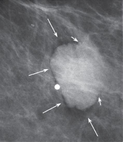 Evaluation And Imaging Features Of Benign Breast Masses Radiology Key