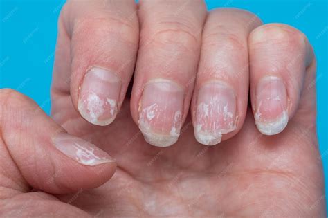 Premium Photo Flaky Bitten And Brittle Nails Without A Manicure