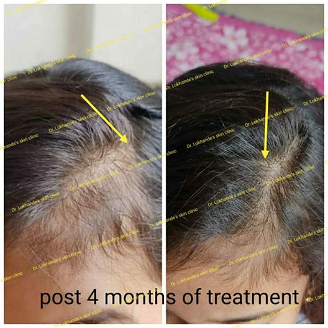 Alopecia Linearis Frontalis Aka Tractional Alopecia Dr Rutuja