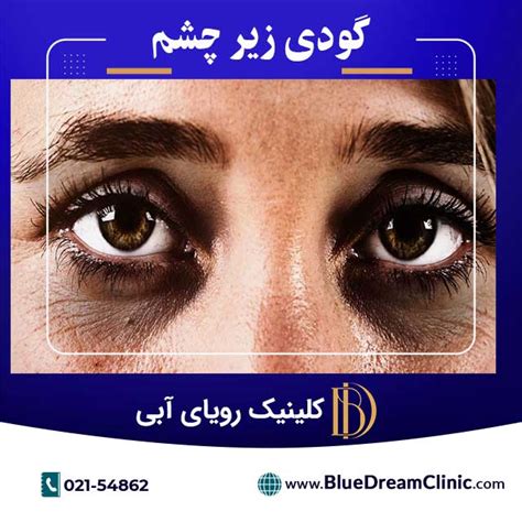 علت گودی زیر چشم چیست و چگونه درمان می شود