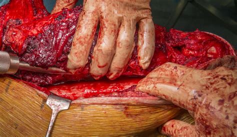 Excision Of Soft Tissue Sarcoma Thigh Surgical Technique Orthoracle