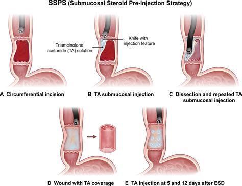 Submucosal Lesion