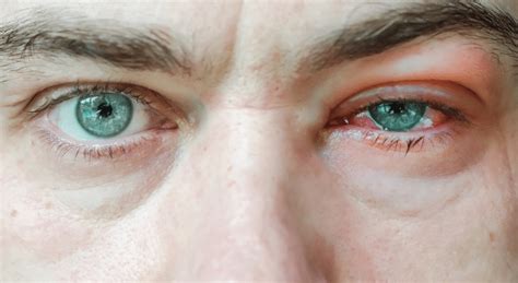 Dry Eyes Blepharitis Could Be To Blame Monterey Bay Eye Center