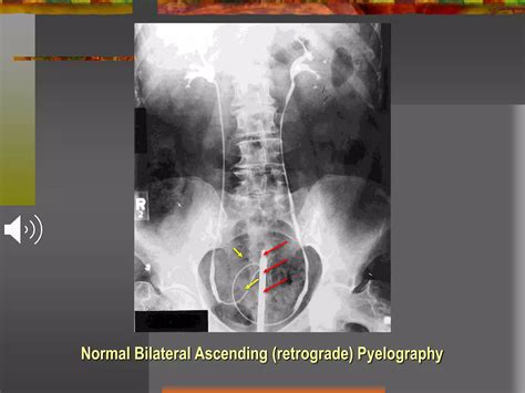 Obstructive Uropathy Online Pptx