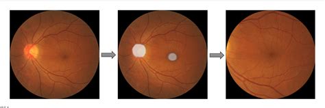 Figure 1 From Synthetic Artificial Intelligence Using Generative Adversarial Network For Retinal