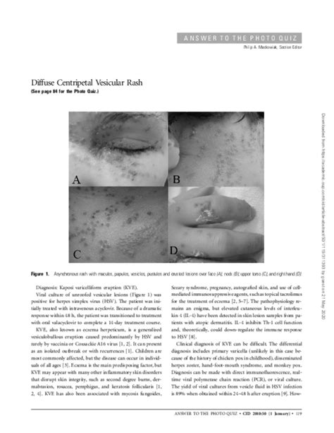 Pdf Diffuse Centripetal Vesicular Rash