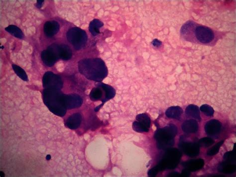 Microphotograph Of Carcinoma Breast Showing Pleomorphic Cells With