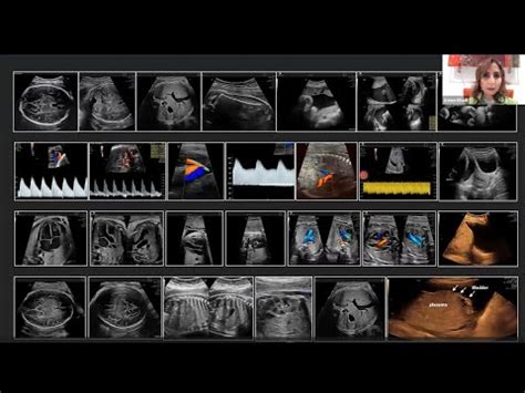 New ISUOG Practice Guidelines The Performance Of A Third Trimester