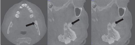 Extracolonic Manifestations Of Gardner Syndrome A Case Report