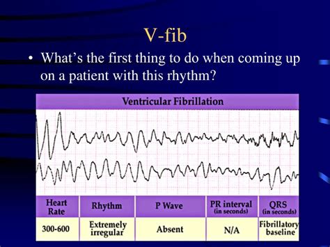 Ppt Ecg Interpretation Powerpoint Presentation Free Download Id 6390619