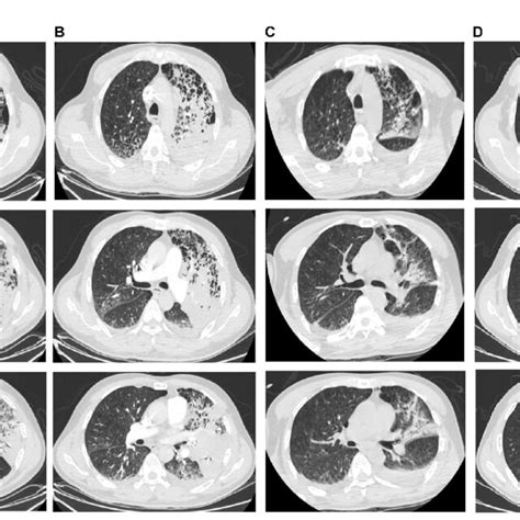 Chest Computed Tomography Images A A Chest Computed Tomography Image Download Scientific
