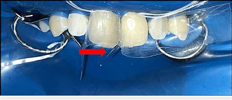 Mylar Strip And Sectional Matrix Used For Closing The Diastema Between