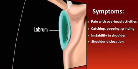 How To Identify And Diagnose A Shoulder Labrum Tear Key Symptoms Now Then Digital