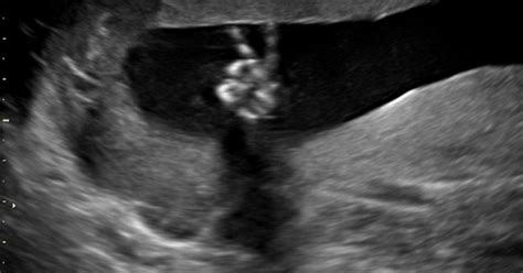 완벽한 V 그린 태아의 초음파 사진 화제