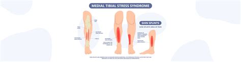 Medial Shin Splints