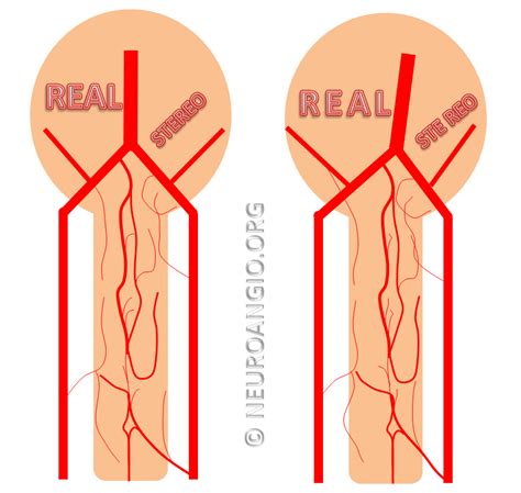 Spinal Arterial Anatomy