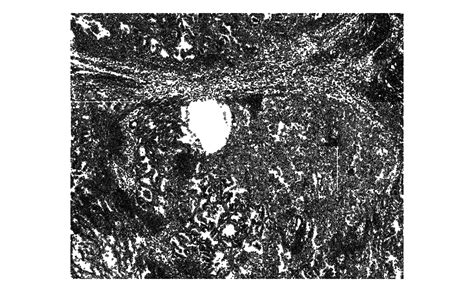 Cosmx Non Small Cell Lung Cancer Data • Voyager