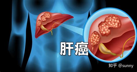 2020 Csco肝癌指南肝癌免疫治疗时代 知乎