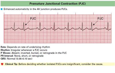 Ecg Educator Blog Premature Junctional Complex Pjc Ecg Educator Blog