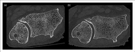 Figure 3 From Photon Counting Detector Computed Tomography Pcd Ct
